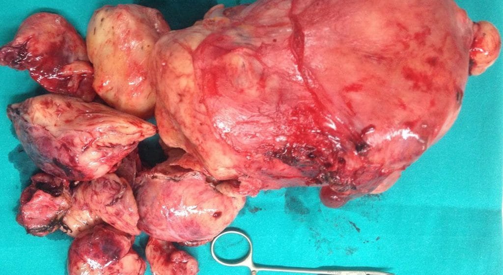Sarcoma uterino - 2023